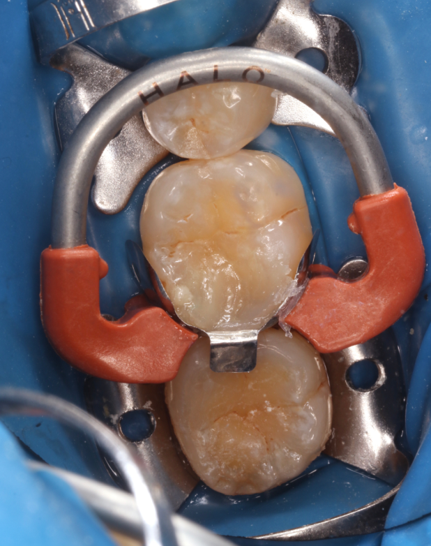 Guide pratique : remplacement d’une obturation fêlée de classe II